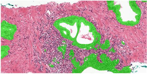 Pathologist Level Gleason Grading Using Artificial Intelligence Ai And Deep Learning Wouter Bulten