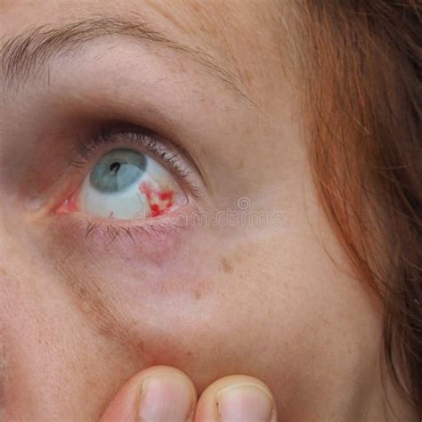 Subconjunctival Hemorrhage Or Subconjunctival Bleeding Hyposhagmus