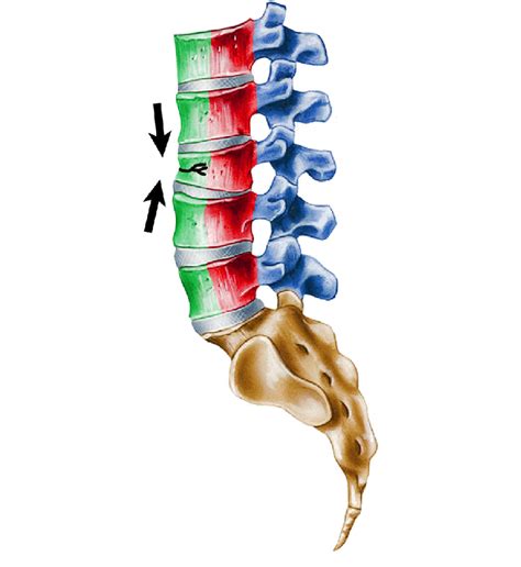 Three Column Spine Concept Depicting Compression Fracture Of The