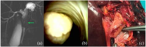 Magnetic Resonance Cholangiography Shows A Filling Defect The Common Download Scientific
