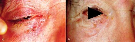 Nodulo Ulcerated BCC A One Year After Segmental Cryosurgery There Download Scientific