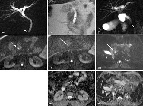 Two Patients With Obstruction Secondary To Cholelithiasis And