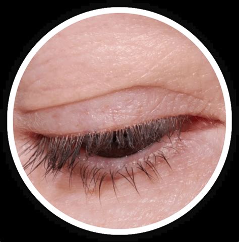 Demodex Blepharitis Xdemvy