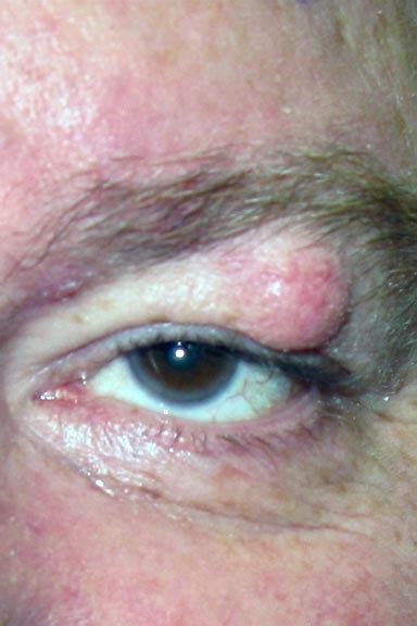 Bump On Eyelid Lumps Lump On Eyelid Bumps Eyelid Surgery Eyelid Surgeon Uk Oculoplastic Surgeon