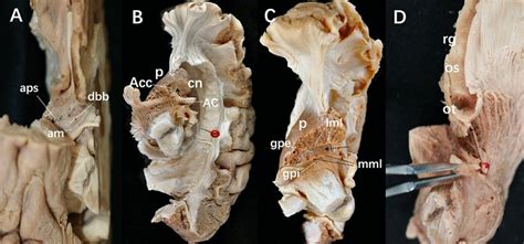 Fiber Dissection From The Inferior Surface Of Right Hemisphere A