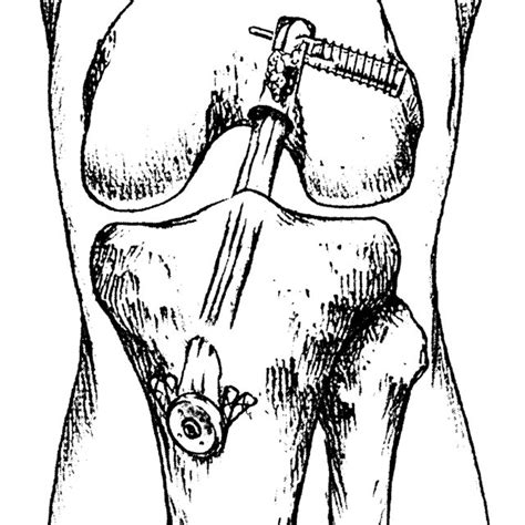 Method Of Acl Reconstruction Download Scientific Diagram