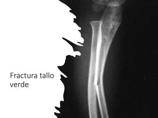 Fracturas En Ninospdf