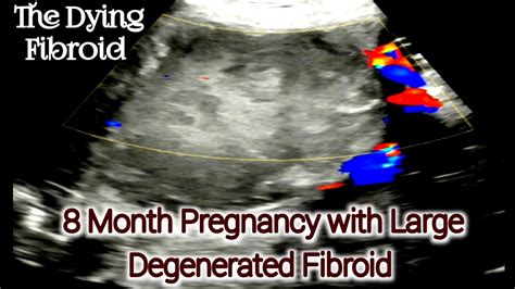 Cystic Uterine Fibroid Ultrasound