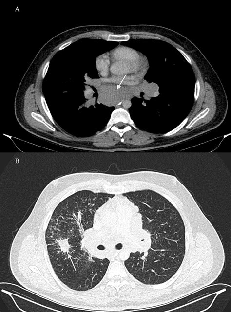 Thoracal Ct Shows The Biggest Lymph Node 5x4 Cm In The Mediastinum