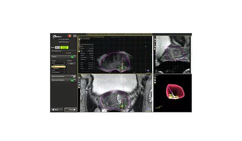 Uronav Philips Philips