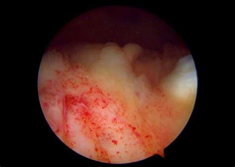 Pvns Treatment Knee Synovectomy Sugar Land Pearland Houston Tx