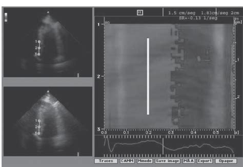 Modo M Color Anatómico En Toma De Cuatro Cámaras Del Septum Basal En Download Scientific