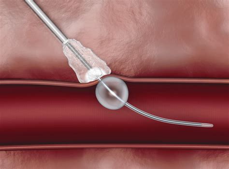 Vascular Mind VASCULAR CLOSURE DEVICES
