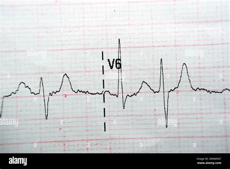 Ecg Electrocardiograph Paper That Shows Normal Sinus Rhythm Nsr With Frequent Pacs Premature