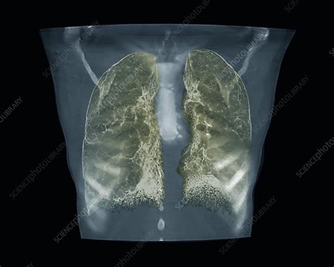 Emphysema Ct Scan Stock Image C048 8771 Science Photo Library