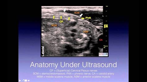 Superficial Cervical Plexus Block Dermatome Dermatomes Chart And Map