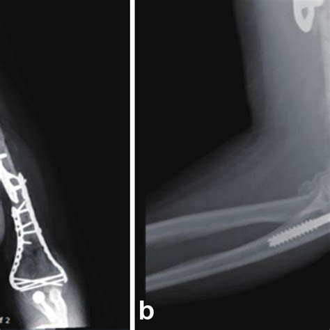 Two Month Postoperative Radiographs Of The Left Humerus A And Left Download Scientific