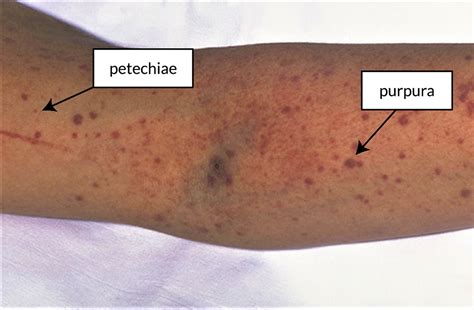 Disseminated Intravascular Coagulation Causes Signs Symptoms Diagnosis And Treatment