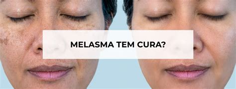 Melasma Confira O Antes E Depois Do Tratamento