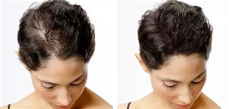 Scalp Micropigmentation Wa Beauty Clinic