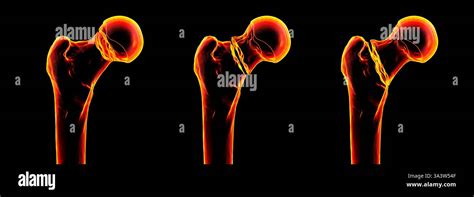 Illustration Of Femur Neck Fracture Types Subcapital Transcervical And Basicervical Stock