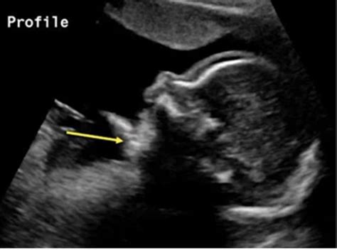 Ob Gyn 3 Final Flashcards Quizlet