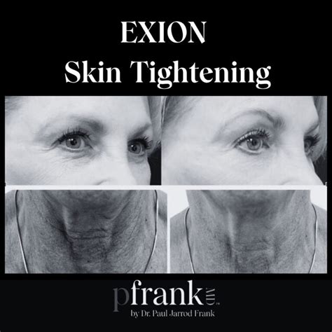 Exion Skin Tightening Pfrankmd By Dr Paul Jarrod Frank