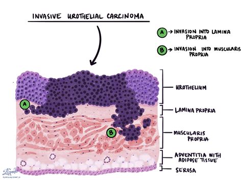 Seu Relatório De Patologia Para Carcinoma Urotelial Mypathologyreport
