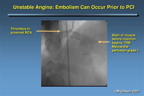 PPT Unstable Angina Embolism Can Occur Prior To PCI PowerPoint Presentation ID