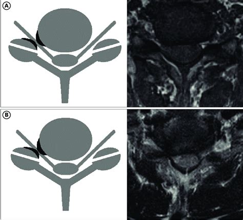 Grading For Cervical Neural Foraminal Stenosis A Grade 1 Non Severe