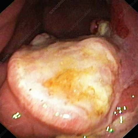 Endoscopy Images Stomach