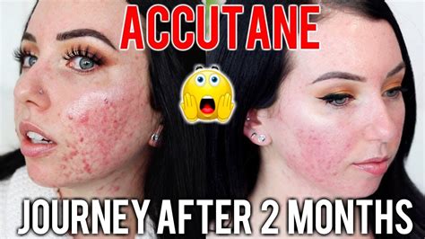Accutane Treatment Length Accutane Dosage Chart Yfmfv