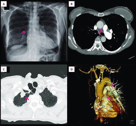 Radiological Findings A Arrow Shows The Hypoplastic Aspect Of The Download Scientific