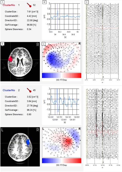 Figure 10 From Fully Automated Spike Detection And Dipole Analysis Of Epileptic Meg Using Deep