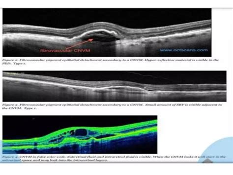 Choroidal Neovascular Membranes Cnvm Pptx