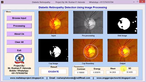 Diabetic Retinopathy Detection Using Image Processing Full Matlab Project Code ~ Matlab Projects