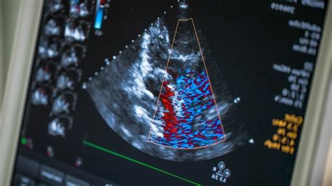 30 Facts About Ectopia Pupillae