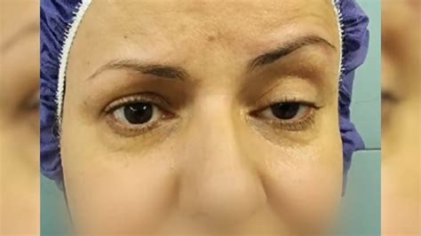 افتادگی پلک نماشا