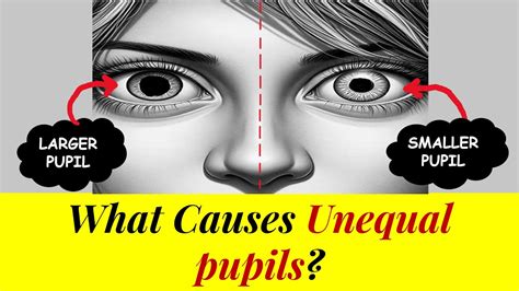 Is Anisocoria Deadly At Carol Bandy Blog