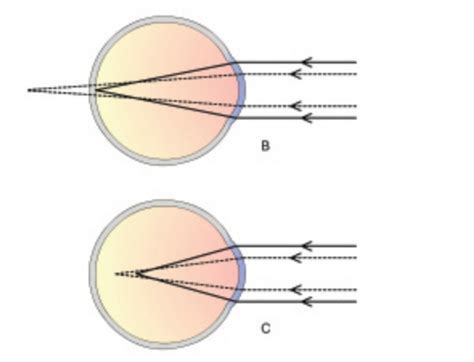 Type Of Astigmatism And Its Treatment