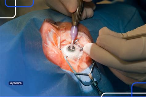 Trabeculectomia O Que é Recuperação Valor E Cid