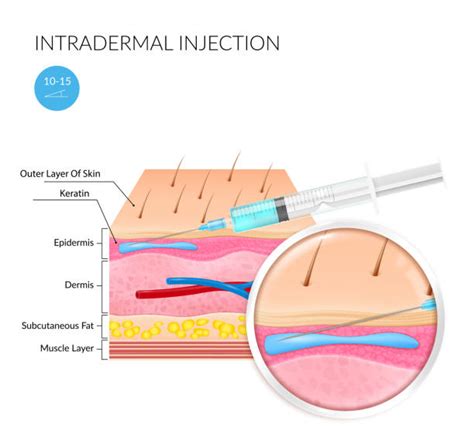Intradermal Injection Sites