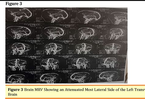 Figure 3 From Unilateral Papilledema Due To Idiopathic Intracranial Hypertension A Case Report