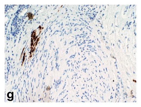 Tumor At The Time Of En Bloc Resection Left Panels Showing Hande A B