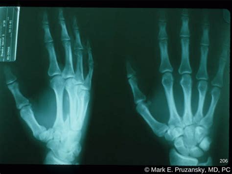 Finger Metacarpal Fractures New York City NY