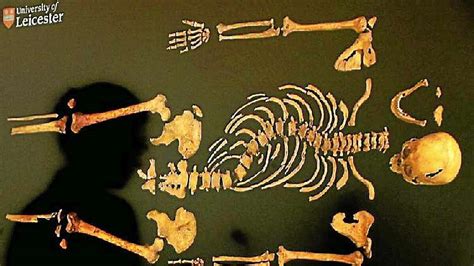Richard Iii Skeleton Scoliosis