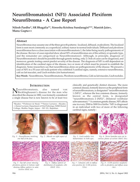 Pdf Neurofibromatosis1 Nf1 Associated Plexiform Neurofibroma A