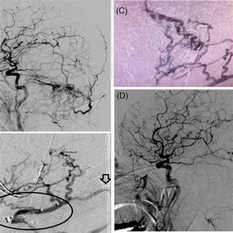 Type 2 Dural Arteriovenous Fistula Davf Lateral View Of A Common Download Scientific Diagram