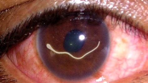 Toxocariasis Ocular Consulta De Oftalmología Pediátrica Dr Alvaro Sanabria