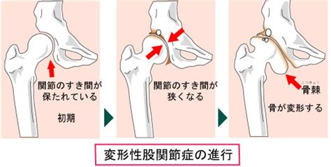 股関節の疾患変形性股関節症について1 原因と症状 医療法人相生会 福岡みらい病院